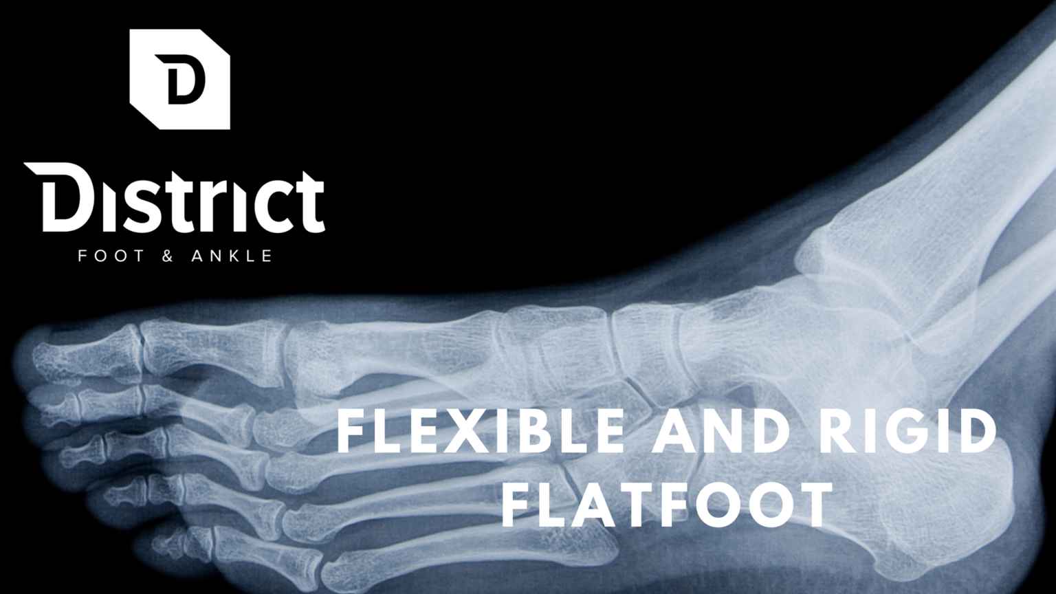What Is the Difference Between Flexible Flatfoot and Rigid Flatfoot ...