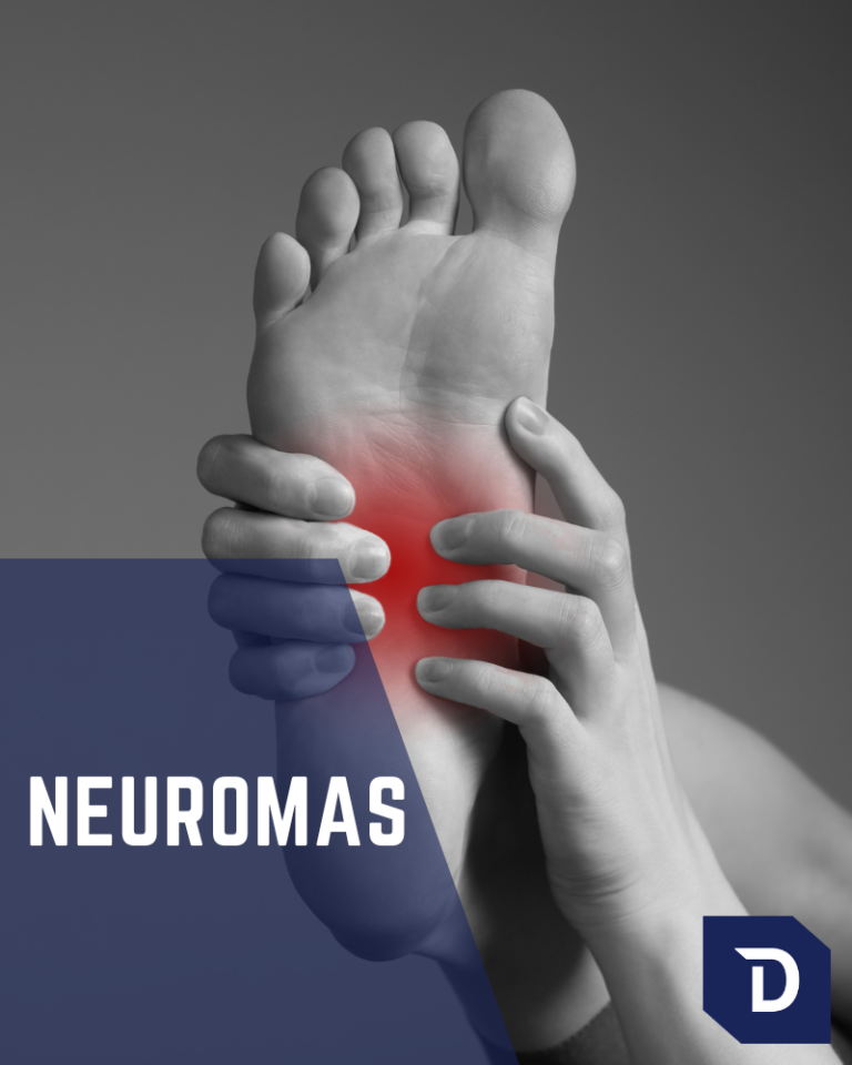 Neuroma Treatment in Alexandria, VA | District Foot & Ankle