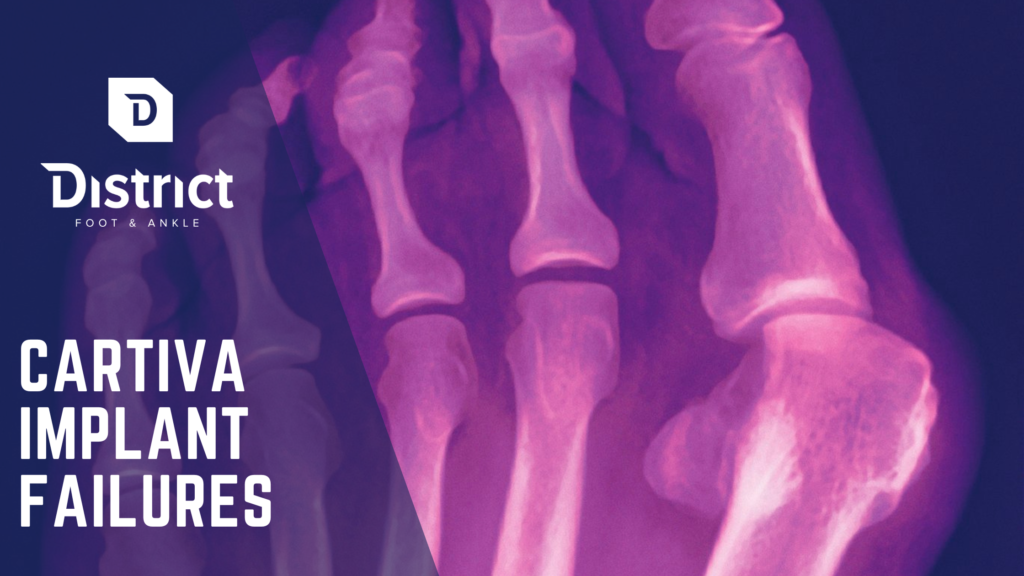 Understanding Cartiva Implant Failures and Next Steps