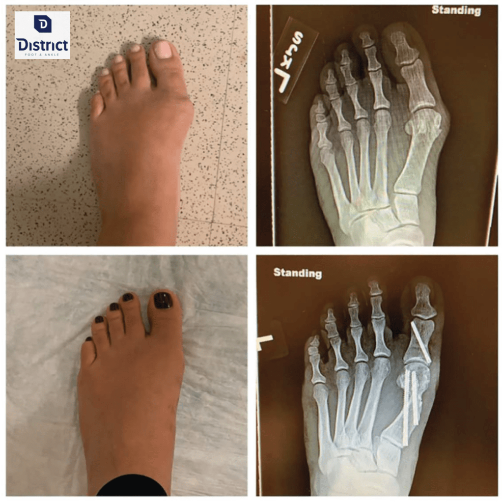 All About Minimally Invasive Bunion Surgery (MIS) – District Foot & Ankle
