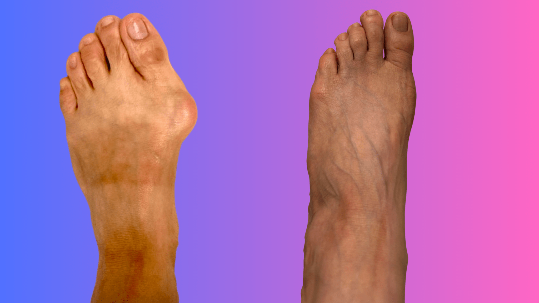 Understanding Minimally Invasive vs. Traditional Bunion Surgery ...